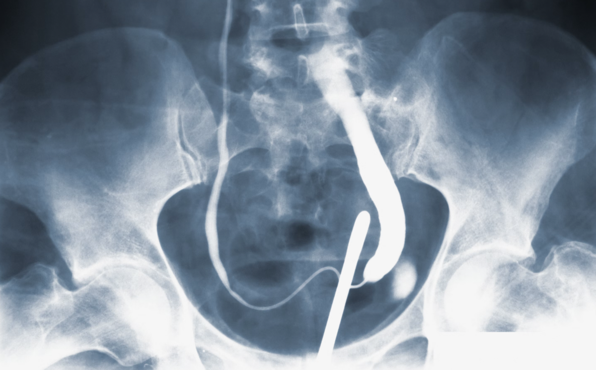 Pelvis Fracture Recovery and Treatment | Focus Physiotherapy in Toronto!