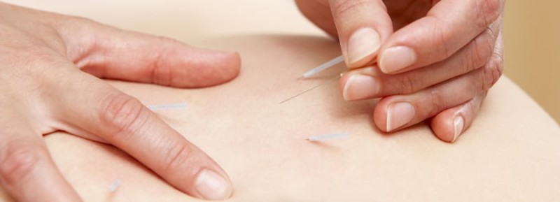 Acupuncture Treatment Near Long Branch | Focus Physiotherapy